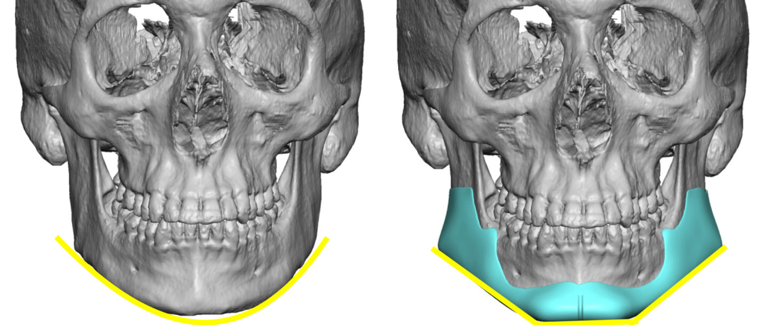 The Principle of the Enhancing Custom Jawline Implant Design - Explore ...