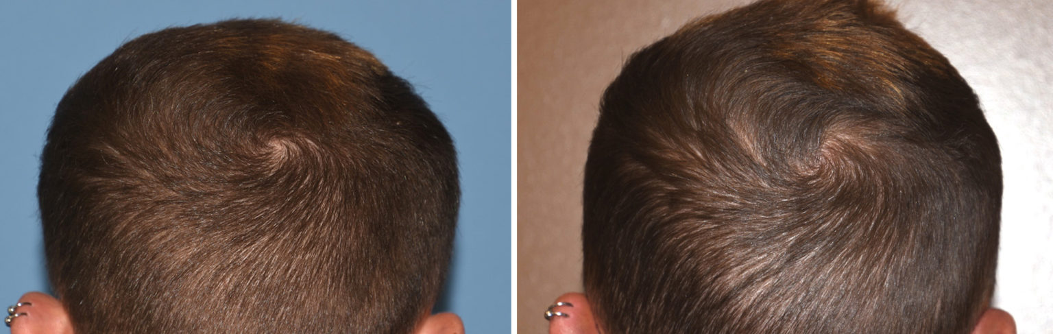 Technical Strategies - The Importance of Deep Fascial Closure in ...