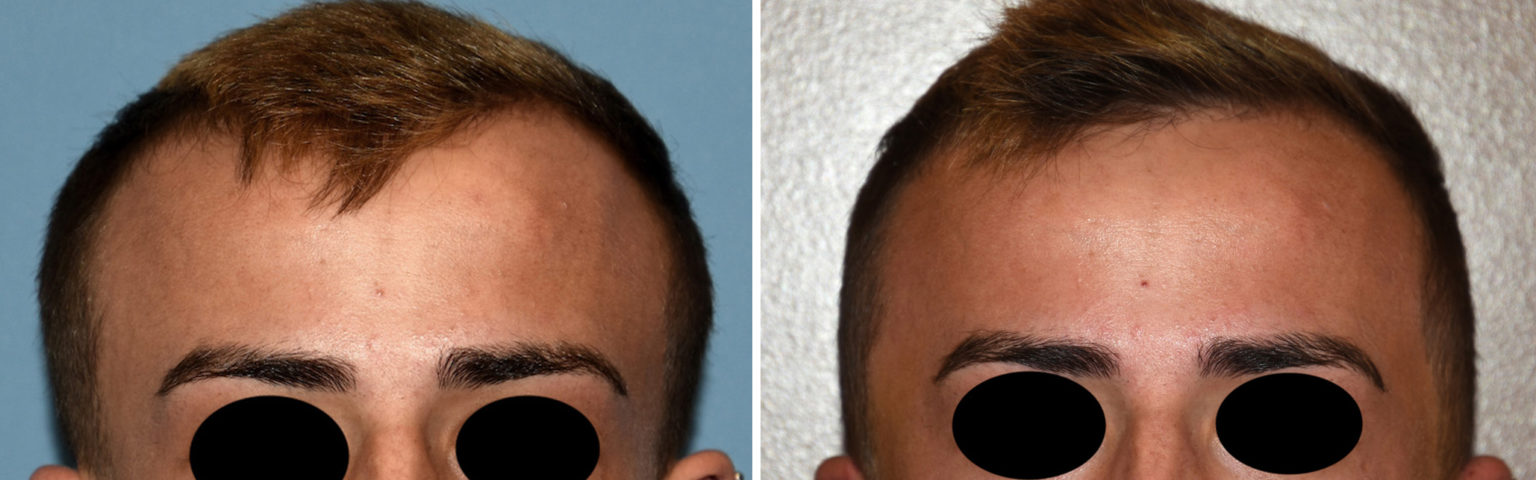 Technical Strategies - The Importance of Deep Fascial Closure in ...