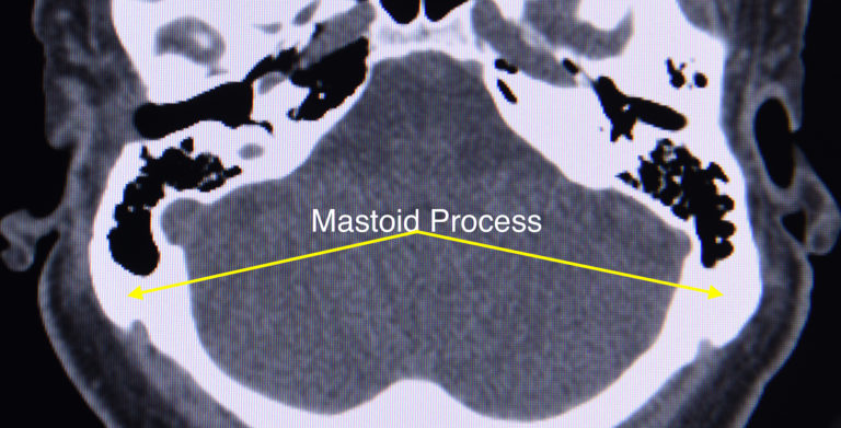 Mastoid Skull Prominences CT scan Dr Barry Eppley Indianapolis ...