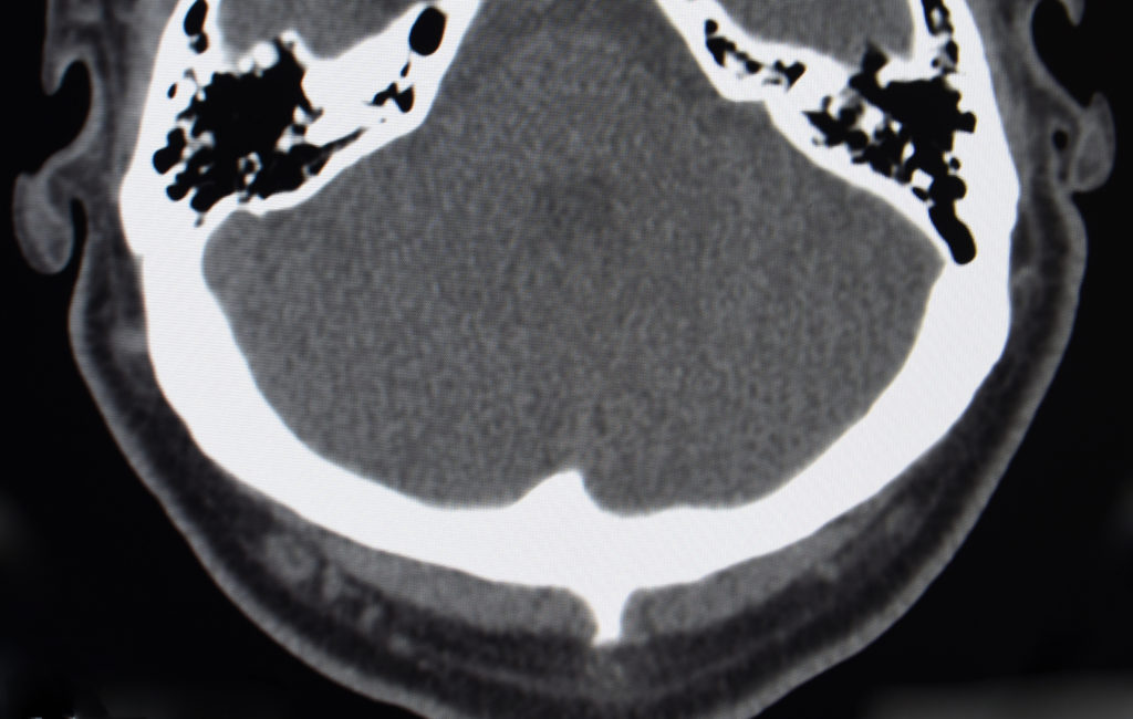 Plastic Surgery Case Study - Occipital Knob and Superior Nuchal Line ...