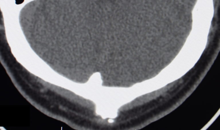The Anatomy of the Occipital Knob Skull Deformity - Explore Plastic Surgery