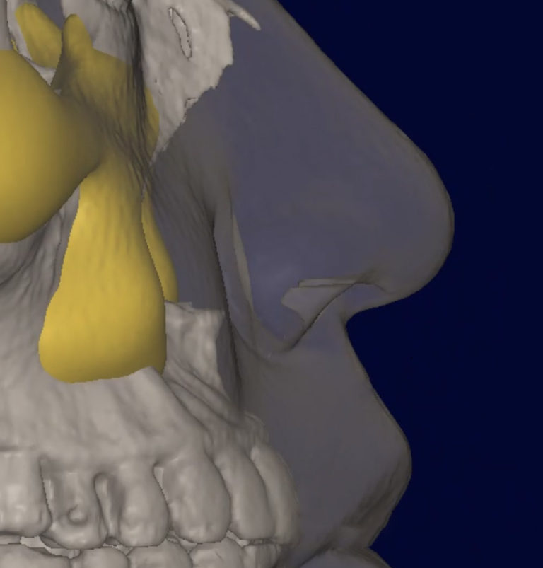The Value of Soft Tissue Nostril Overlay on Custom Paranasal Implant ...