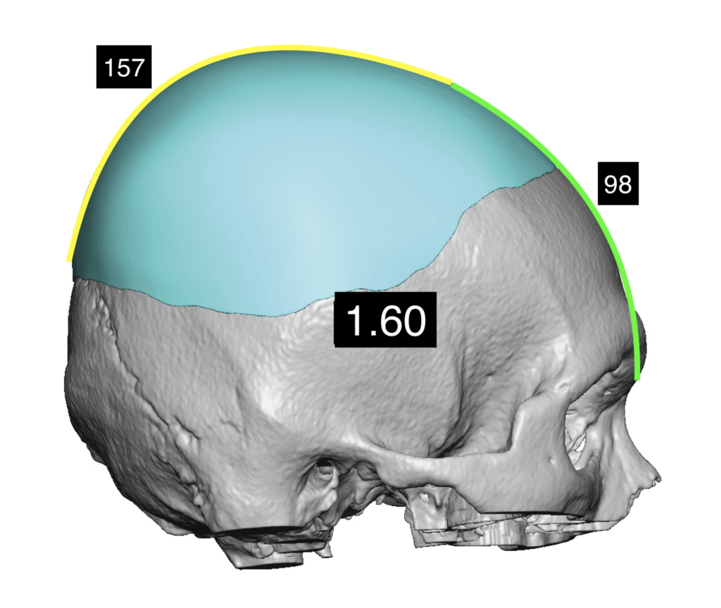 Custom Skull Implant Designs for Aesthetic Head Reshaping and the ...