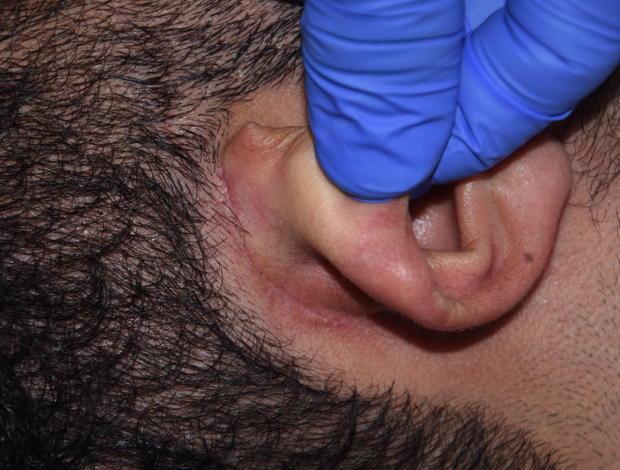 The Postauricular Approach for Temporal Implant Placement - Explore ...