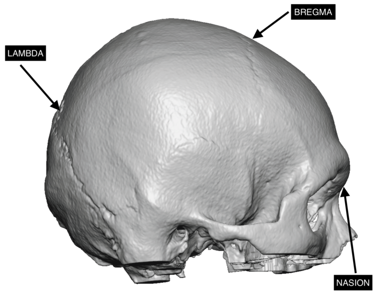 Custom Skull Implant Designs for Aesthetic Head Reshaping and the ...