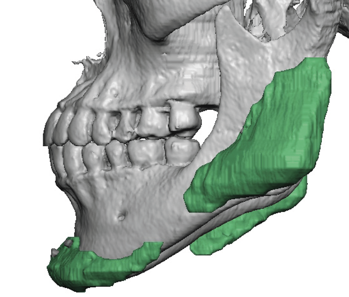 Plastic Surgery Case Study - Custom Jawline Implant Replacement of ...