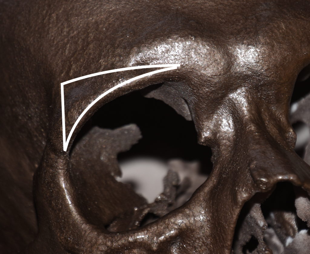 Temporal Brow Bone Reduction Zone Dr Barry Eppley Indianapolis ...