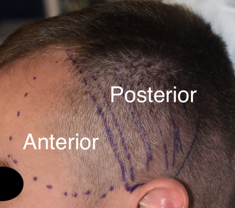 Technical Strategies - The Importance of Deep Fascial Closure in ...