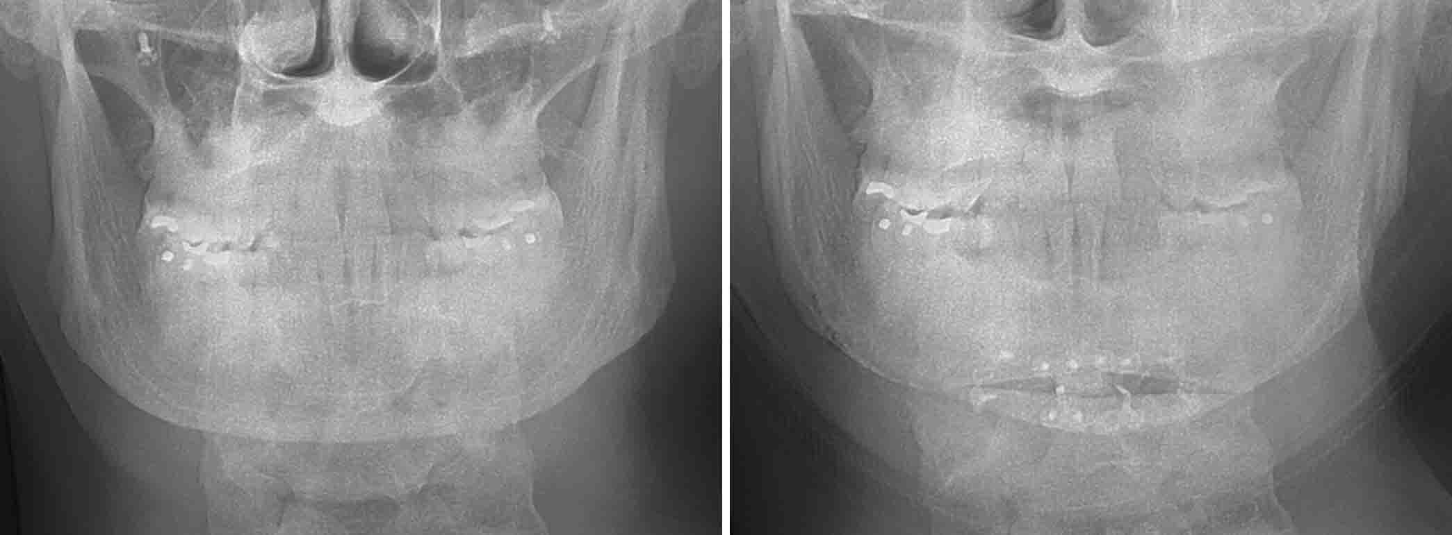 V Line surgery result front view x-rays Dr Barry Eppley Indianapolis ...