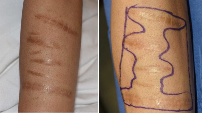 Wide Excision of Arm Scars Dr Barry Eppley Indianapolis - Explore ...