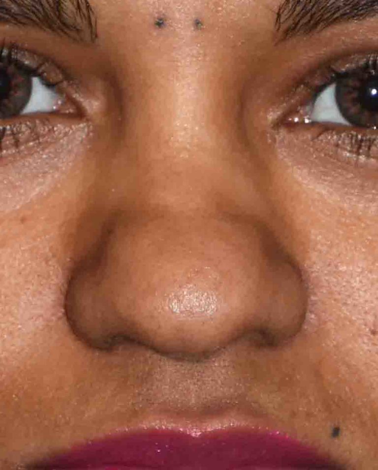 The Bulbous Nose Rhinoplasty - Explore Plastic Surgery