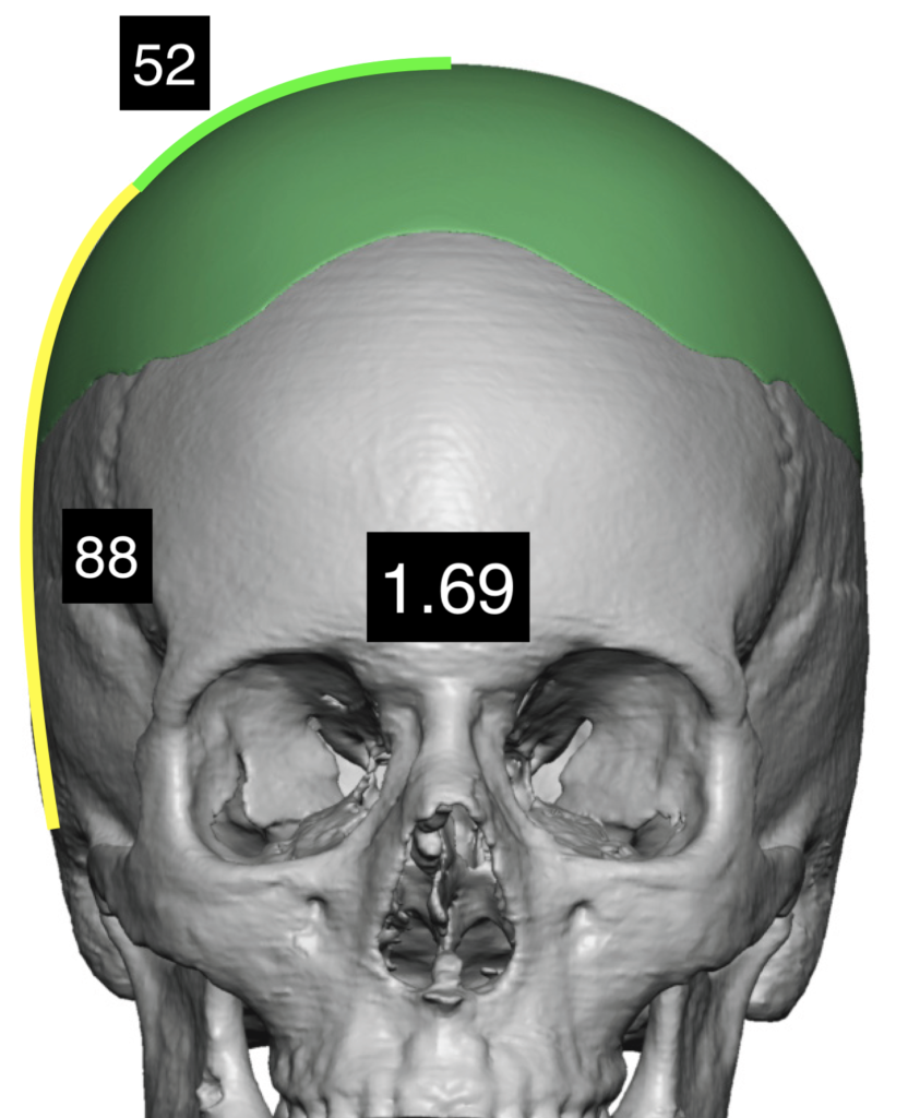 Custom Skull Implant Designs for Aesthetic Head Reshaping and the ...