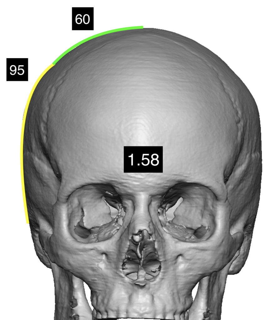 Custom Skull Implant Designs for Aesthetic Head Reshaping and the ...