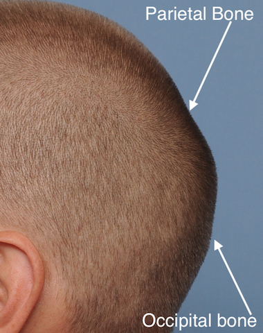 Plastic Surgery Case Study - Back of Head Prominence Skull Reduction ...
