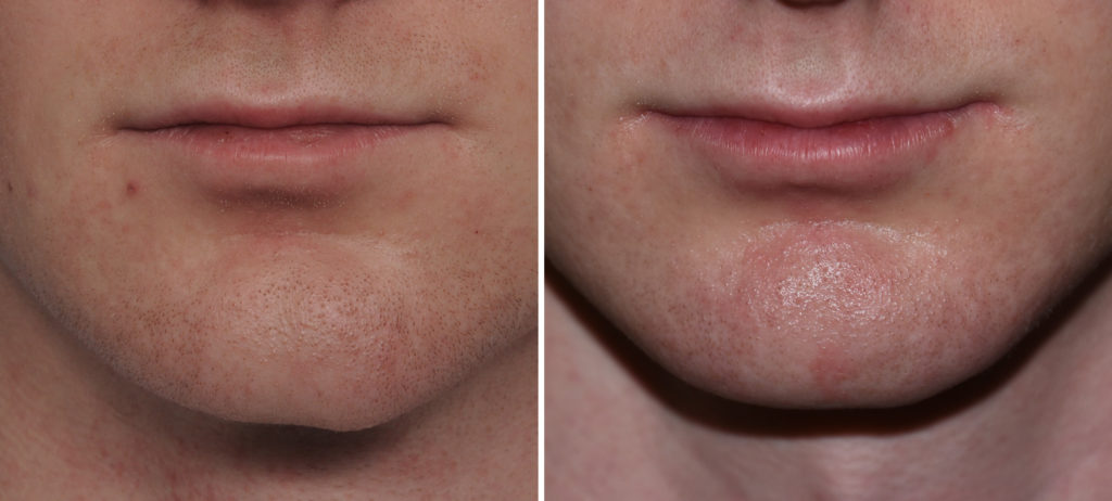 Plastic Surgery Case Study - Submental Inferior Border Shave Technique ...