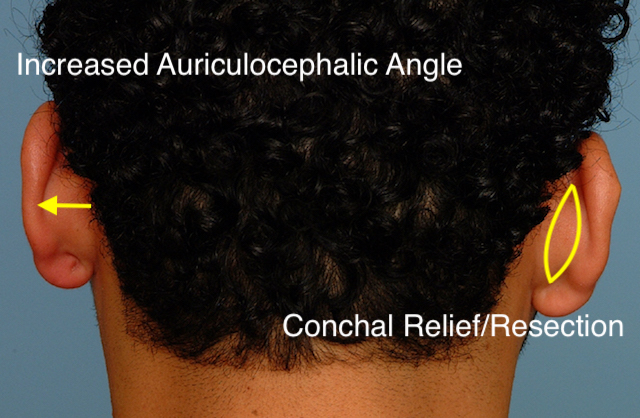 Plastic Surgery Case Study - Setback Otoplasty with Conchal Reduction ...