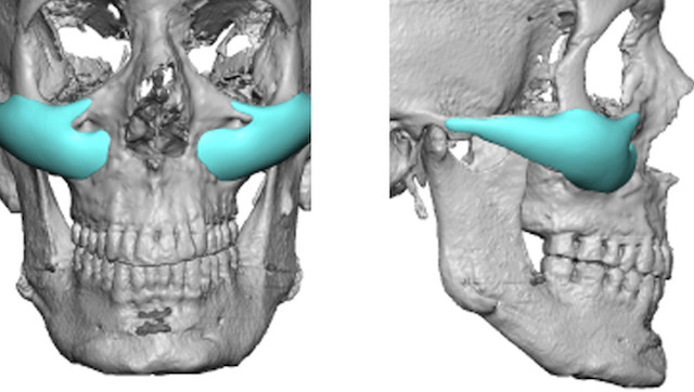 Facial Masculinization Surgery - Middle Third Reshaping - Cheek Bone ...