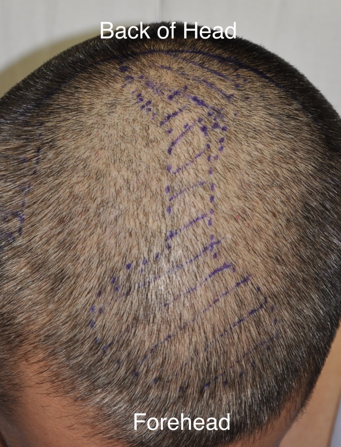 Reduction of the Dumb Bell-Shaped Sagittal Crest Skull Deformity ...