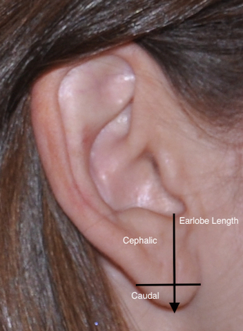 Earlobe Reduction of the Age-Related Long Ear - Explore Plastic Surgery
