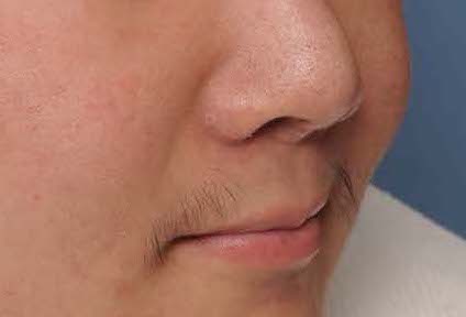 The Influence of Premaxillary and Paranasal Augmentation on the Nose ...