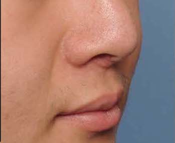 The Influence of Premaxillary and Paranasal Augmentation on the Nose ...