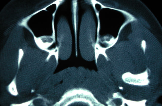 Plastic Surgery Case Study - Open Reduction and Internal Fixation of A ...