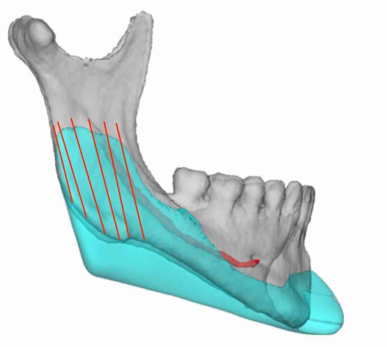 The Anatomy of Masseteric Muscle Dehiscence vs Implant Reveal In Jaw ...