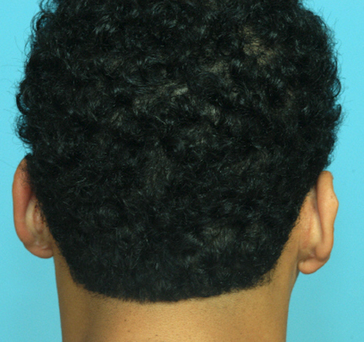 Plastic Surgery Case Study - Setback Otoplasty with Conchal Reduction ...