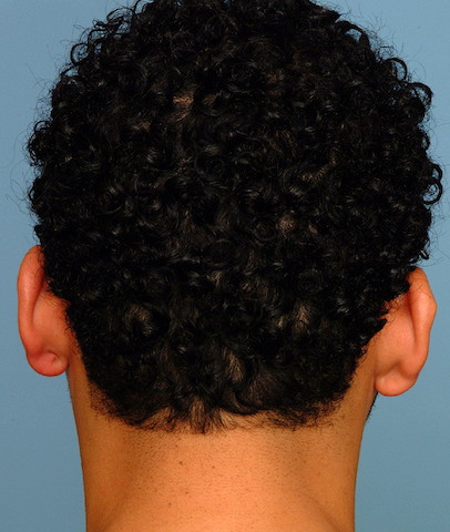 Plastic Surgery Case Study - Setback Otoplasty with Conchal Reduction ...