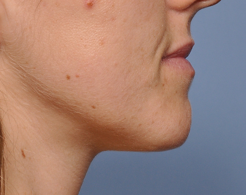 Postoperative Instructions - Chin Reduction Surgery - Explore Plastic ...