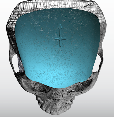 Design Guidelines for Female Custom Forehead Implants - Explore Plastic ...