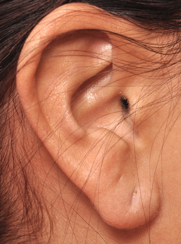 Earlobe Reduction of the Age-Related Long Ear - Explore Plastic Surgery