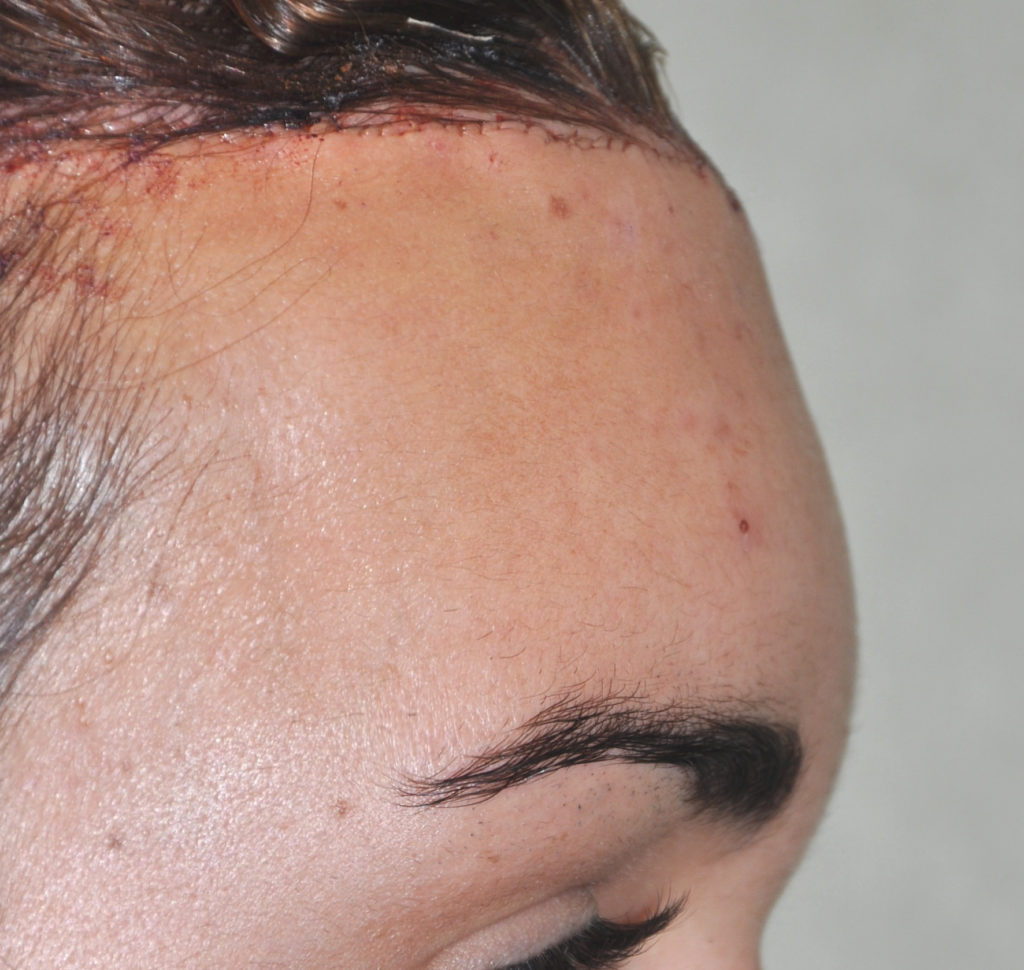Plastic Surgery Case Study - Frontal Hairline Advancement with Frontal ...