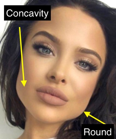 The 3D Anatomy of the Jaw Angles and Its Implication in Custom Jawline ...