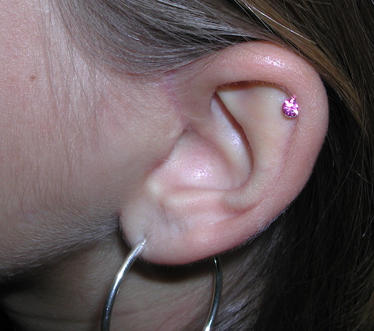 Plastic Surgery Case Study - Open Reduction and Internal Fixation of A ...