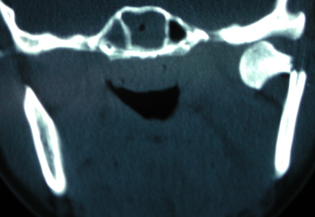left subcondylar fracture 2 CT scan Dr Barry Eppley Indianapolis ...