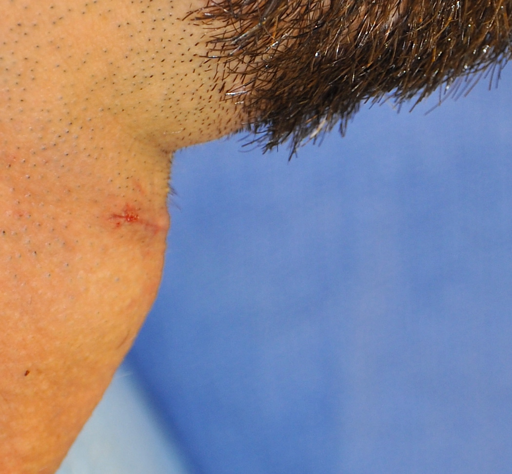 Plastic Surgery Case Study - Reducing the Overly Prominent Adam's Apple ...