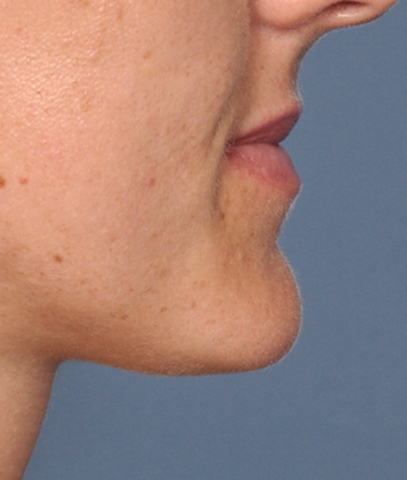 Facial Feminization Surgery - Lower Third Reshaping - II. Chin ...