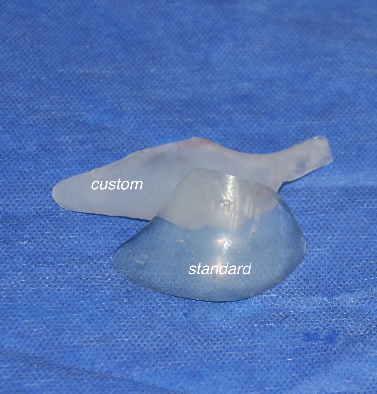 Plastic Surgery Case Study - Male Custom Cheek Implant Replacements for ...