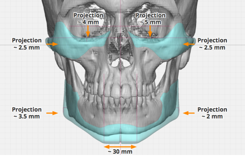 Custom Facial Implants - I. Introduction and Overview - Explore Plastic ...