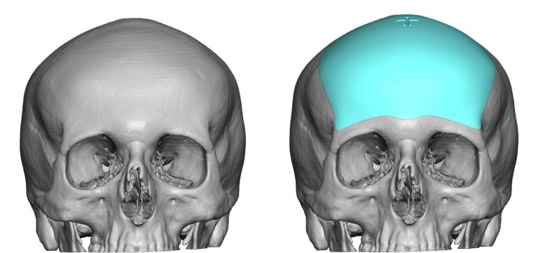 Custom Facial Implants - X. Forehead Reshaping - Explore Plastic Surgery