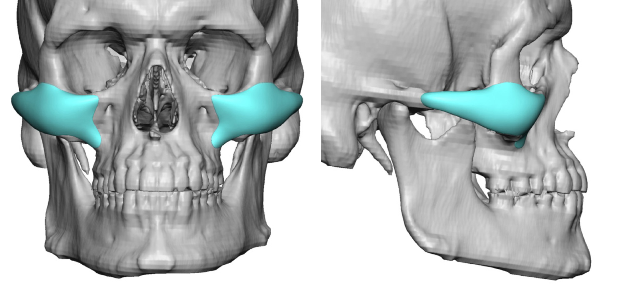 Custom Facial Implants - IV. The High Cheekbone Look - Explore Plastic ...
