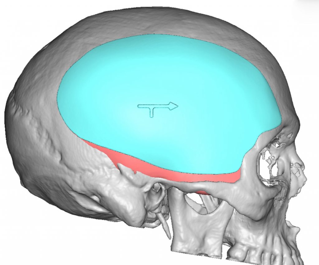 Custom Facial Implants - XI. Wider Foreheads and Enhanced Head Widths ...