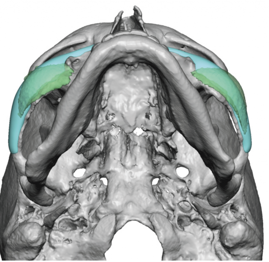 Plastic Surgery Case Study - Male Custom Cheek Implant Replacements for ...