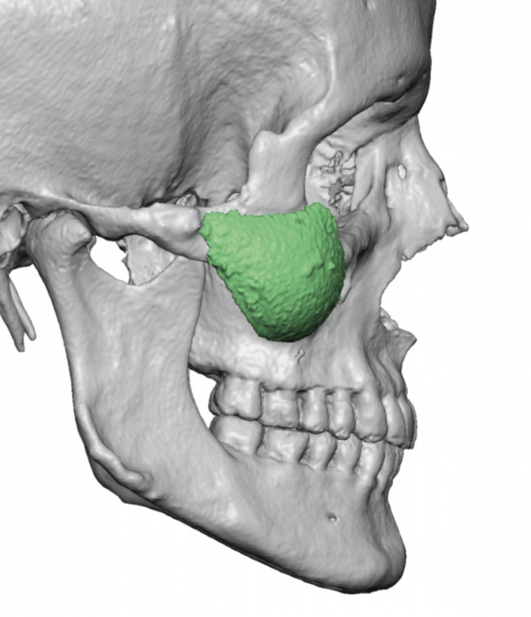 Plastic Surgery Case Study - Male Custom Cheek Implant Replacements for ...