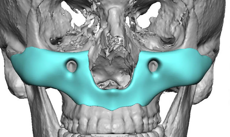Custom Facial Implants - VII. Pulling the Midface Forward - Explore ...