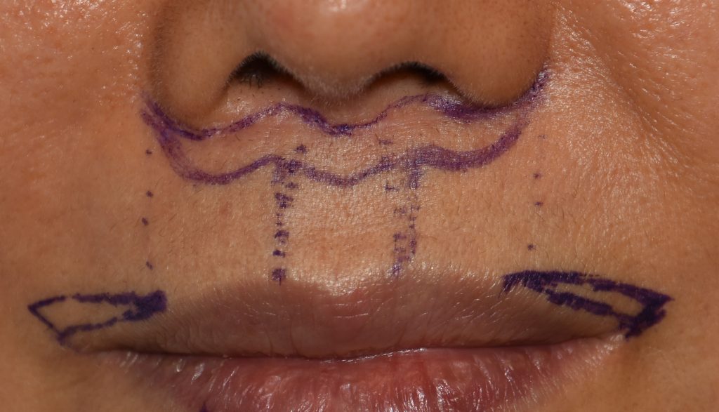 Technical Strategies: Avoiding Upper Lip Vermilion Disproportion in ...