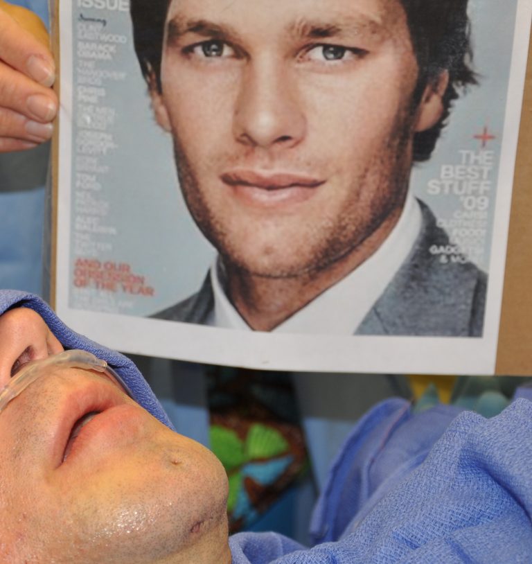 The Tom Brady Chin Dimple Procedure - Explore Plastic Surgery