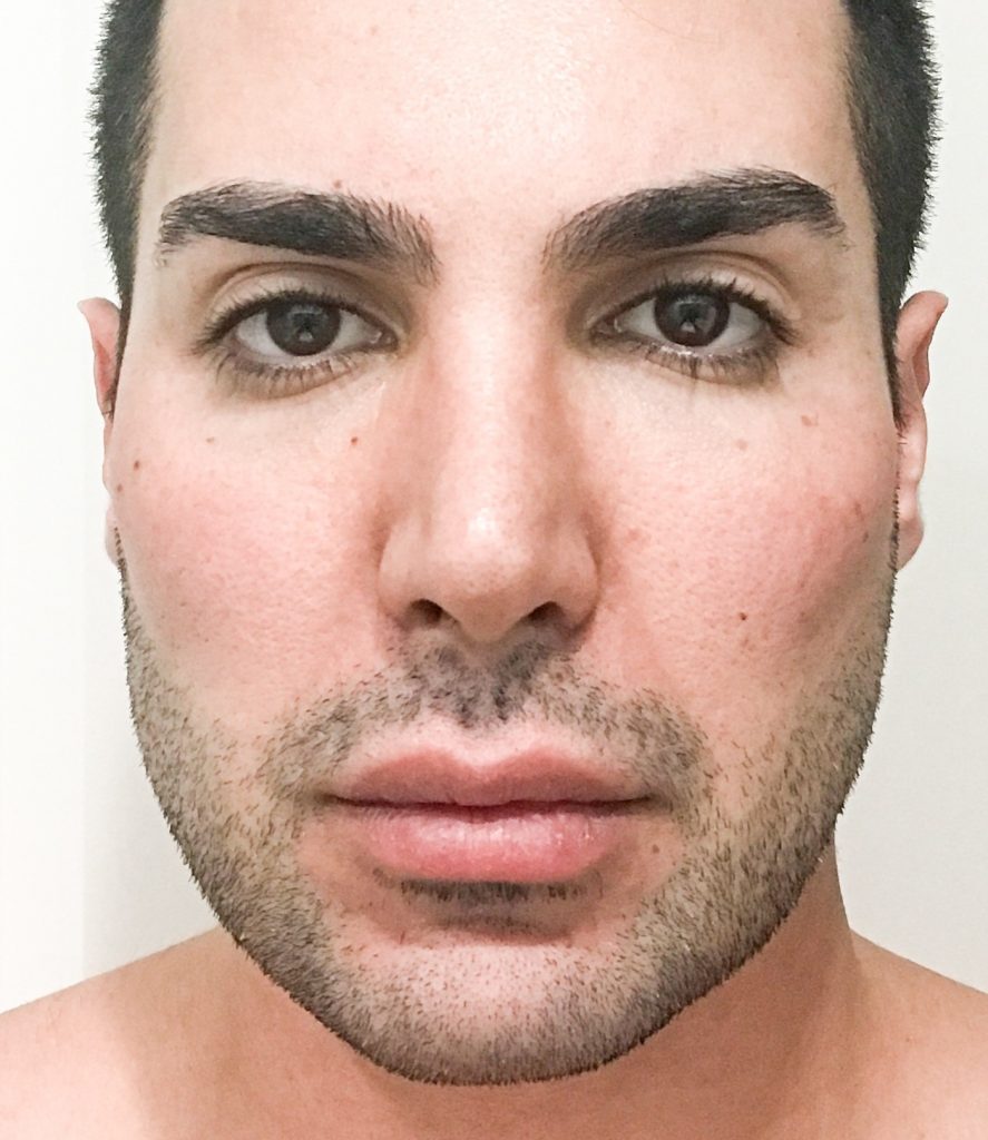 Custom Facial Implants - II. 3D Chin and Jaw Angle Reshaping - Explore ...